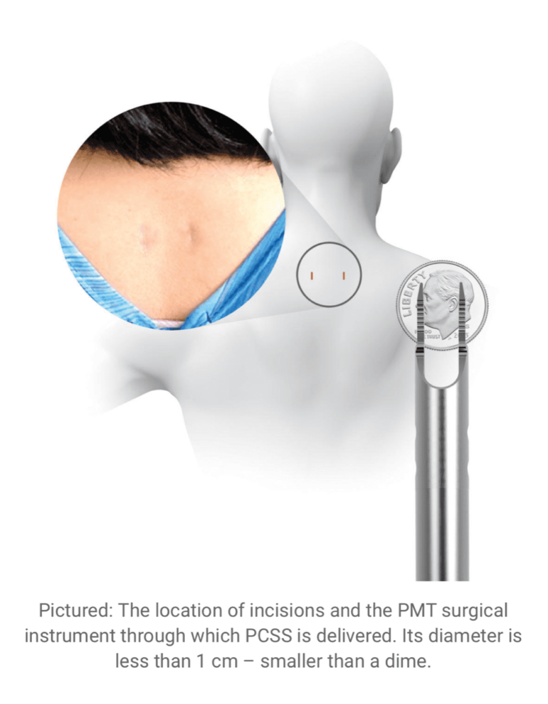 Minimally Invasive Posterior Cervical Fusion - San Antonio Spine ...