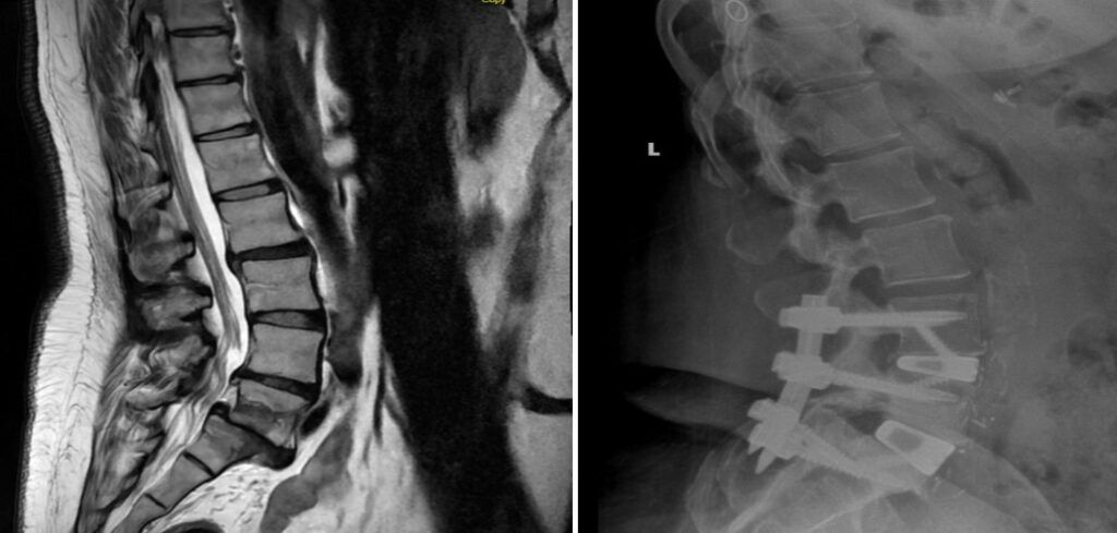 Spondylithesis - Before and After Surgery - Spine Surgeon - Antonio ...